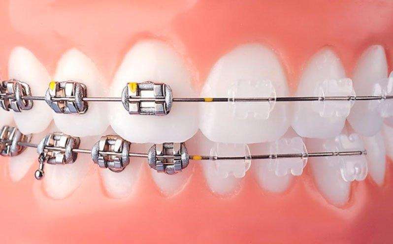 Aparelho transparente quanto custa - Consulta Ideal