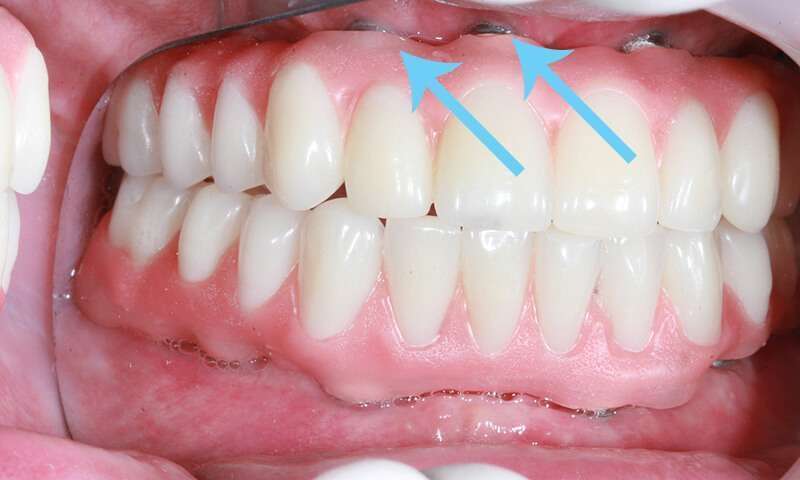 Prótese protocolo - Consulta Ideal